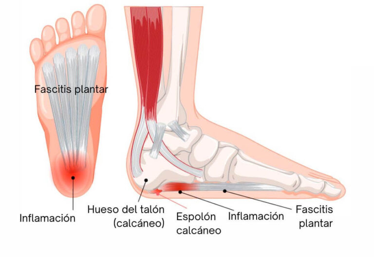 Espolón Calcáneo: Causas, Síntomas y Tratamiento